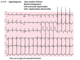 Stepwise interpretation of ECG - #08 no Dx ID478 | PPT