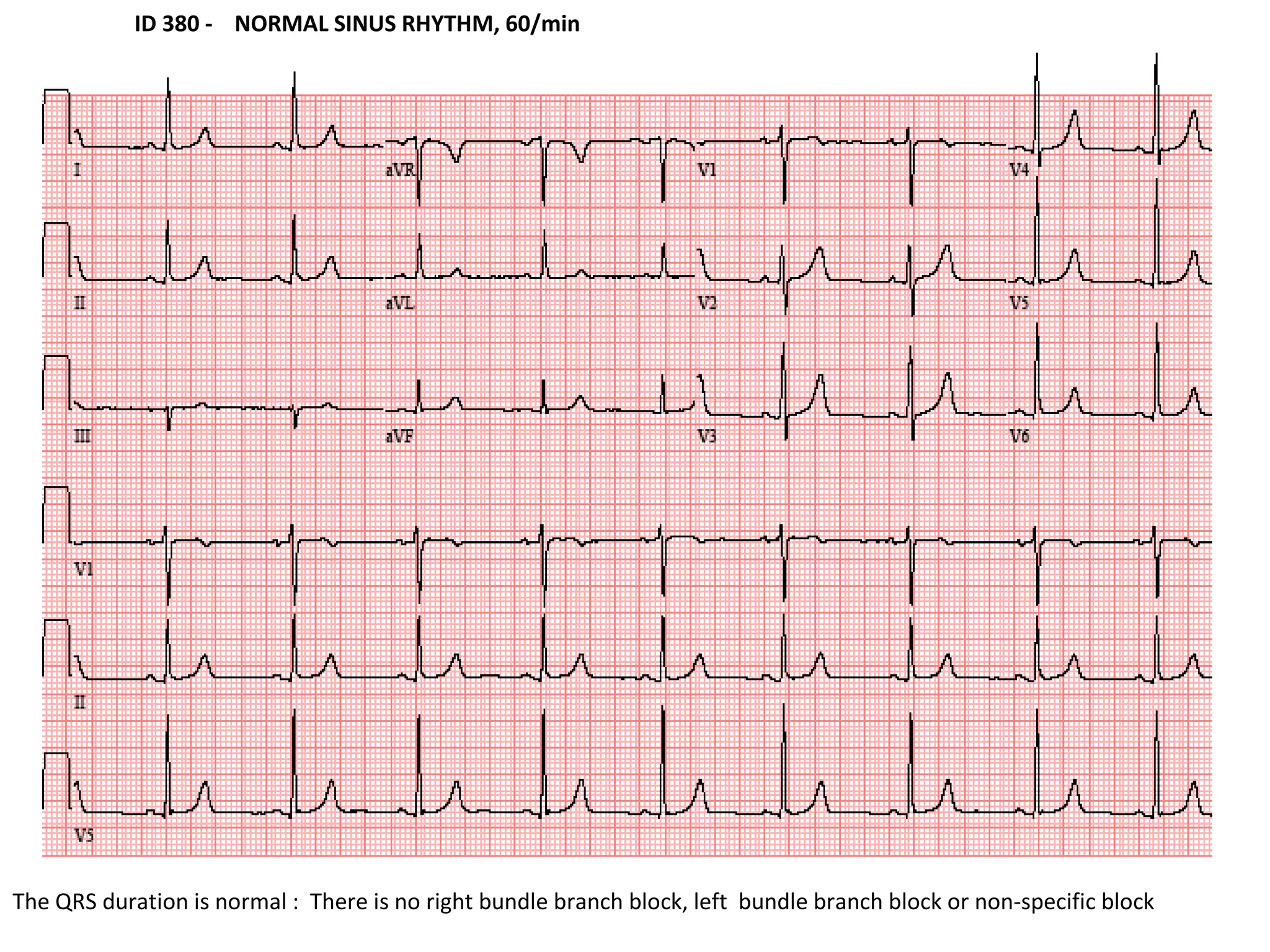 Stepwise interpretation of ECG - #1 ID 380 | PPT