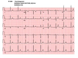 Stepwise interpretation of ECG - #1 ID 380 | PPT