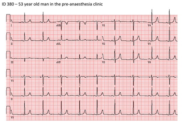 Stepwise interpretation of ECG - #1 ID 380 | PPT