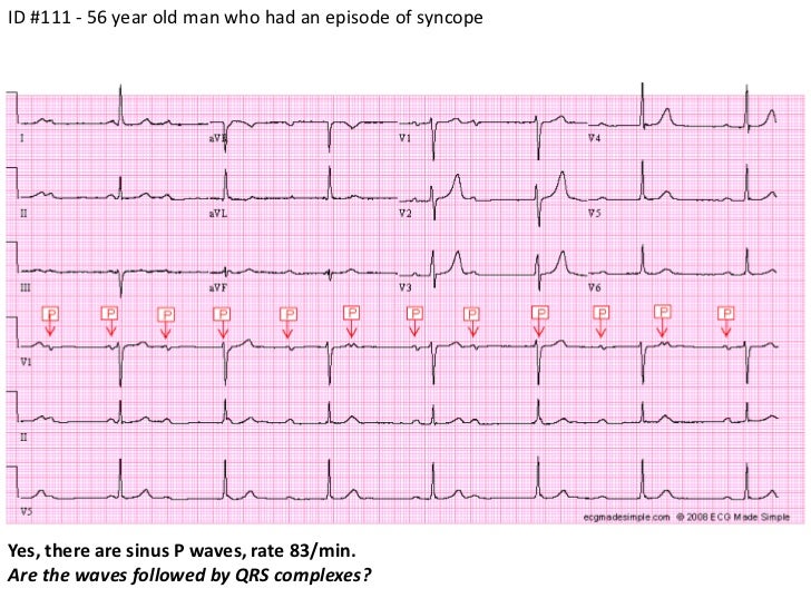 Stepwise interpretation of ECG - #12 no Dx ID 111