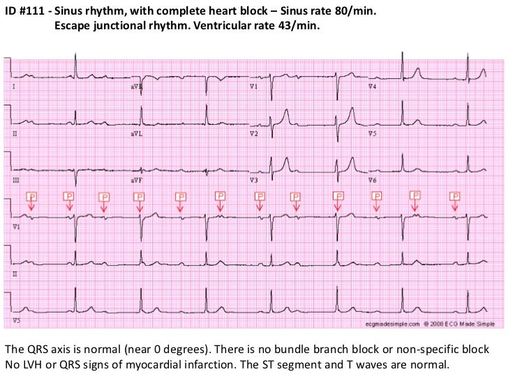 Stepwise interpretation of ECG - #12 no Dx ID 111