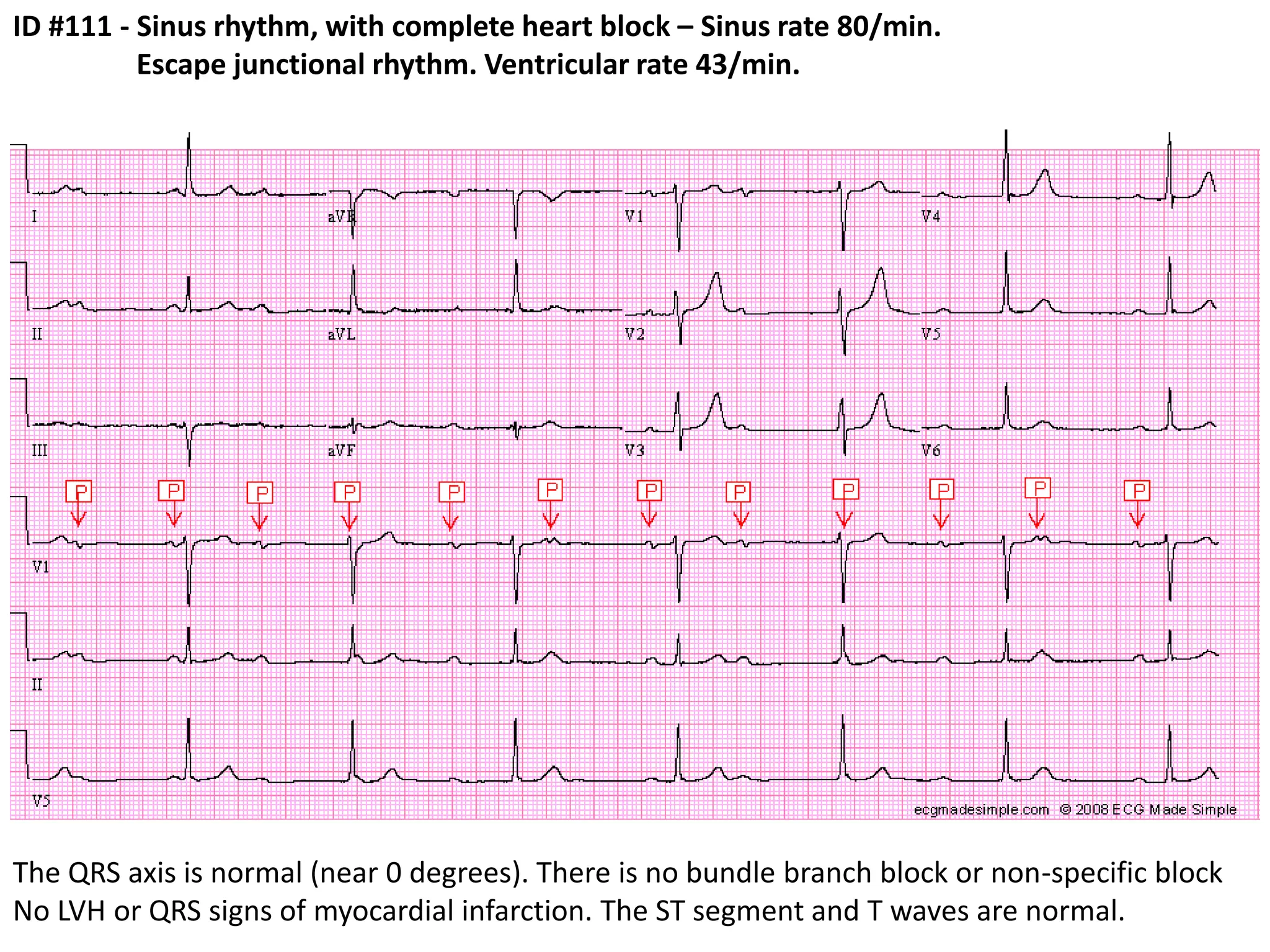 Stepwise interpretation of ECG - #12 no Dx ID111 | PPTX
