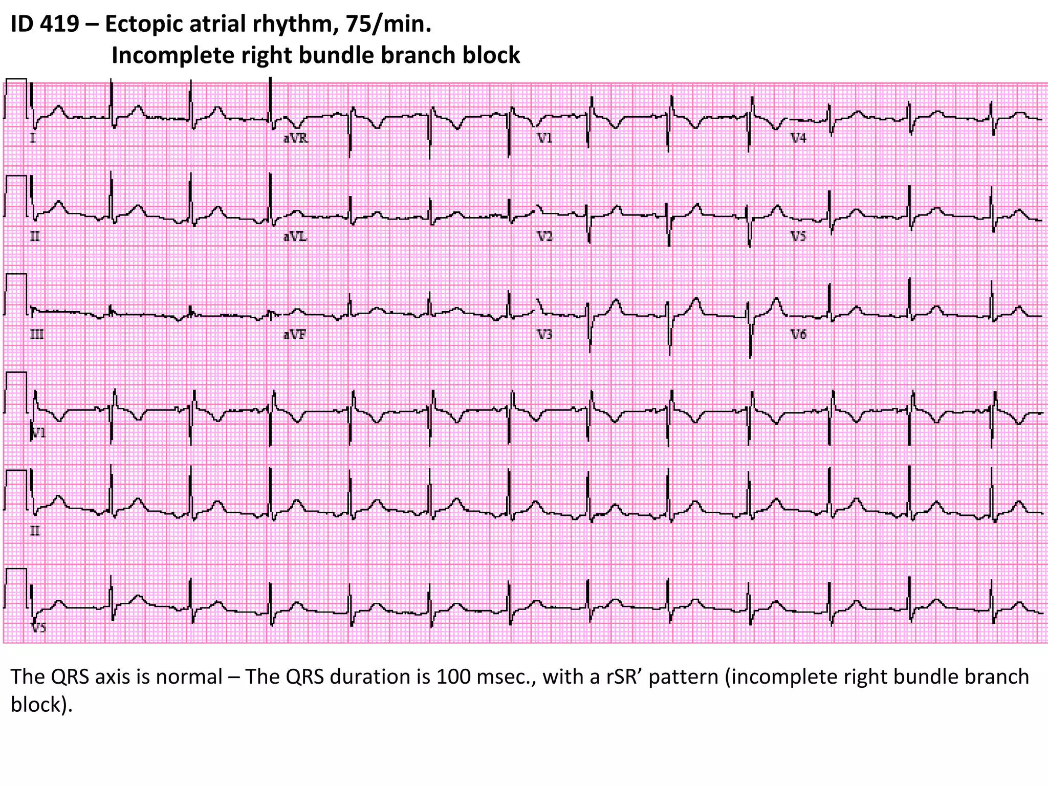 Stepwise interpretation of ECG - #13 no Dx ID 419 | PPT