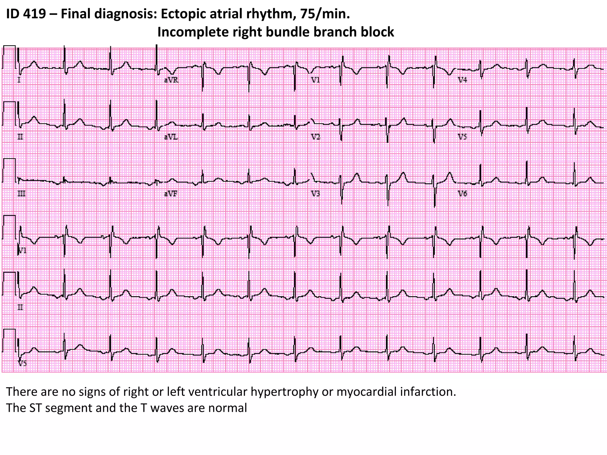 Stepwise interpretation of ECG - #13 no Dx ID 419 | PPT