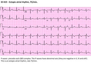 Stepwise interpretation of ECG - #13 no Dx ID 419 | PPT