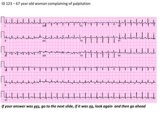 Stepwise interpretation of ECG - #14 no Dx ID123 | PPT | Free Download