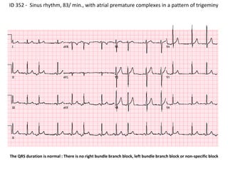 Stepwise interpretation of ECG - #2 ID352 | PPT