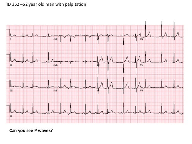 Stepwise interpretation of ECG - #2 ID352