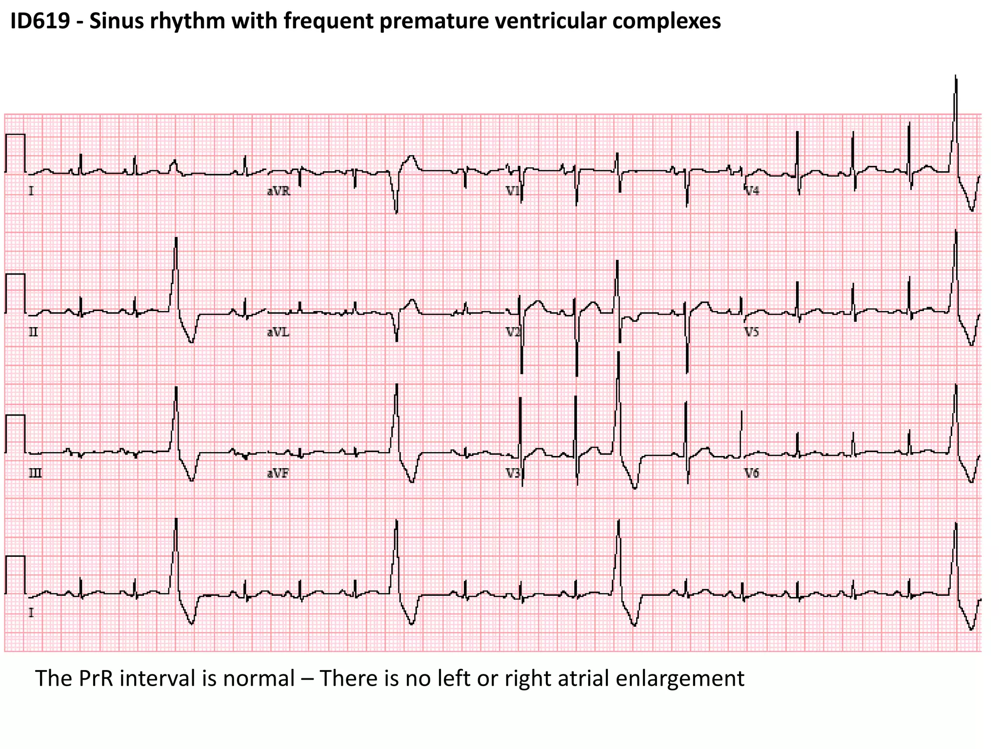Stepwise interpretation of ECG - #3 ID659 | PPTX | Heart and ...