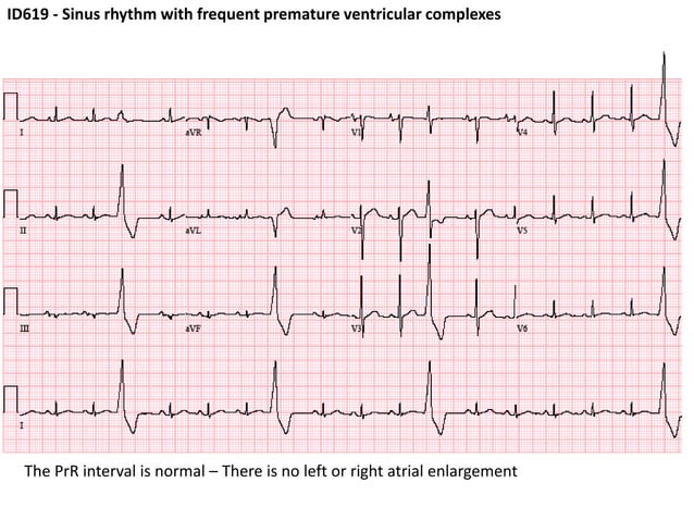 Stepwise interpretation of ECG - #3 ID659 | PPTX | Heart and ...