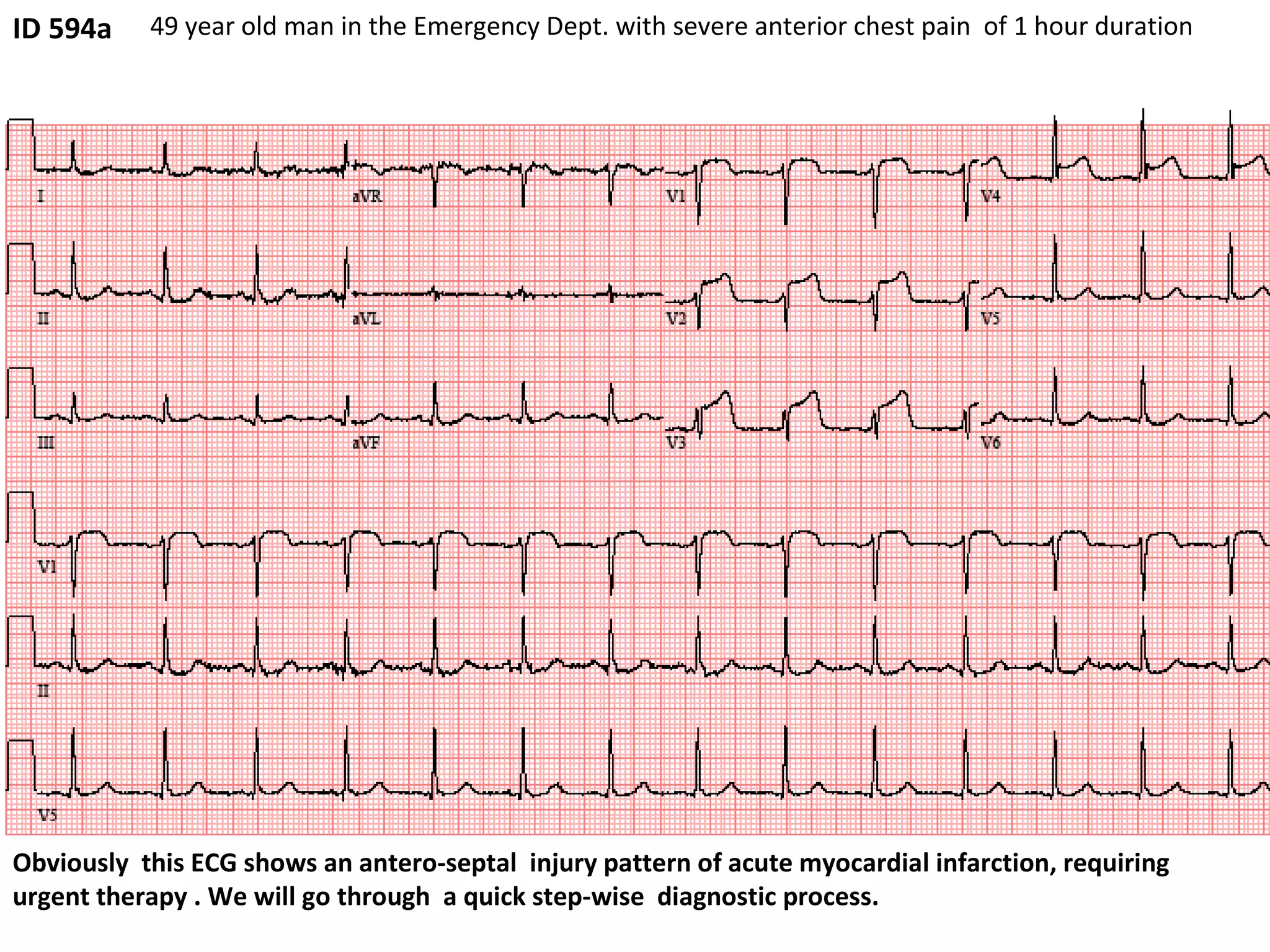 Stepwise interpretation of ECG - #9 no Dx ID 594 | PPT