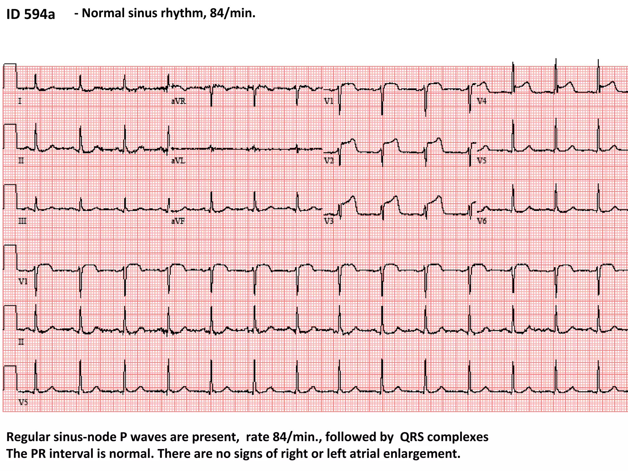 Stepwise interpretation of ECG - #9 no Dx ID 594 | PPT | Heart and Cardiovascular Diseases ...