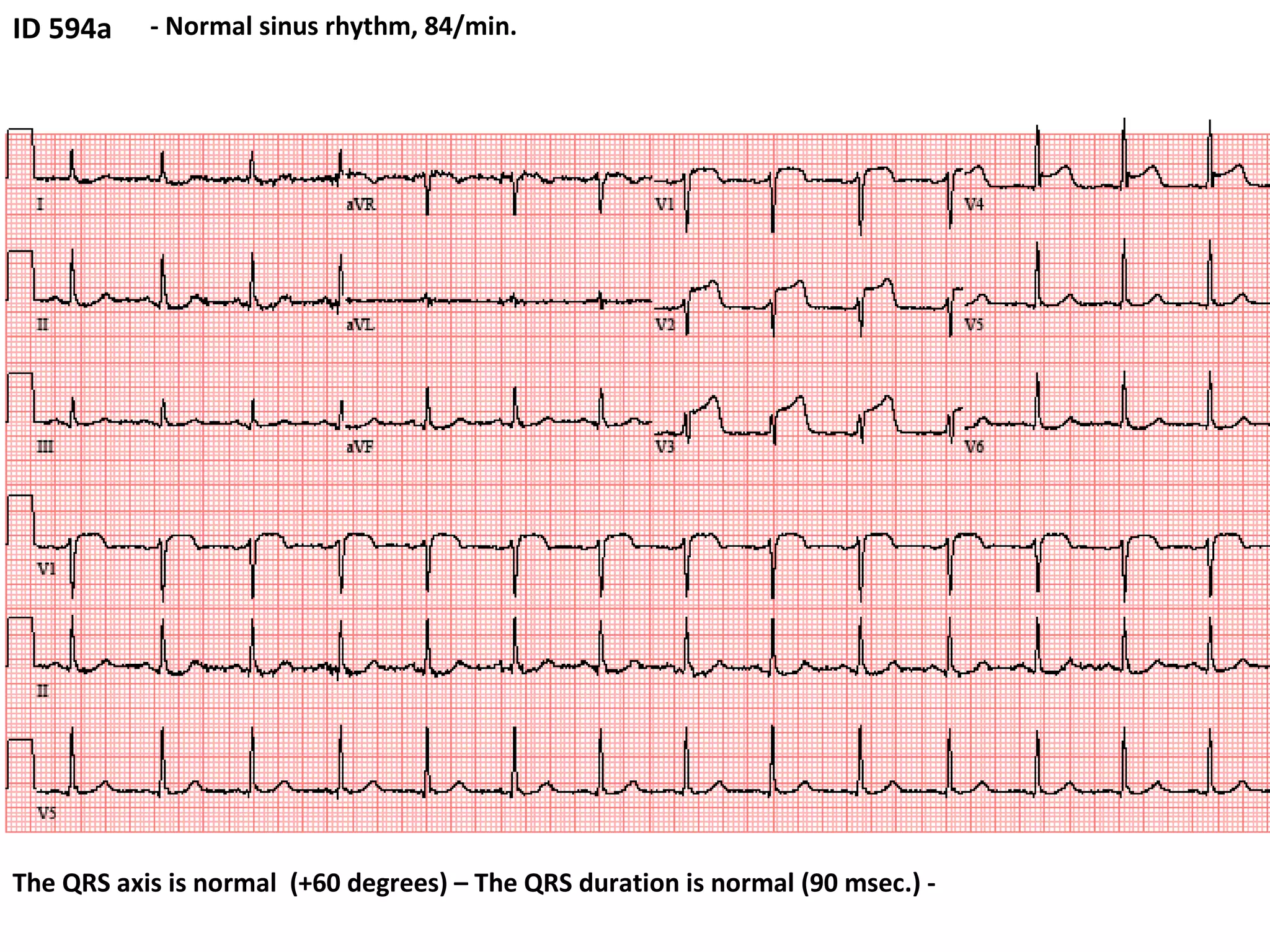 Stepwise interpretation of ECG - #9 no Dx ID 594 | PPT