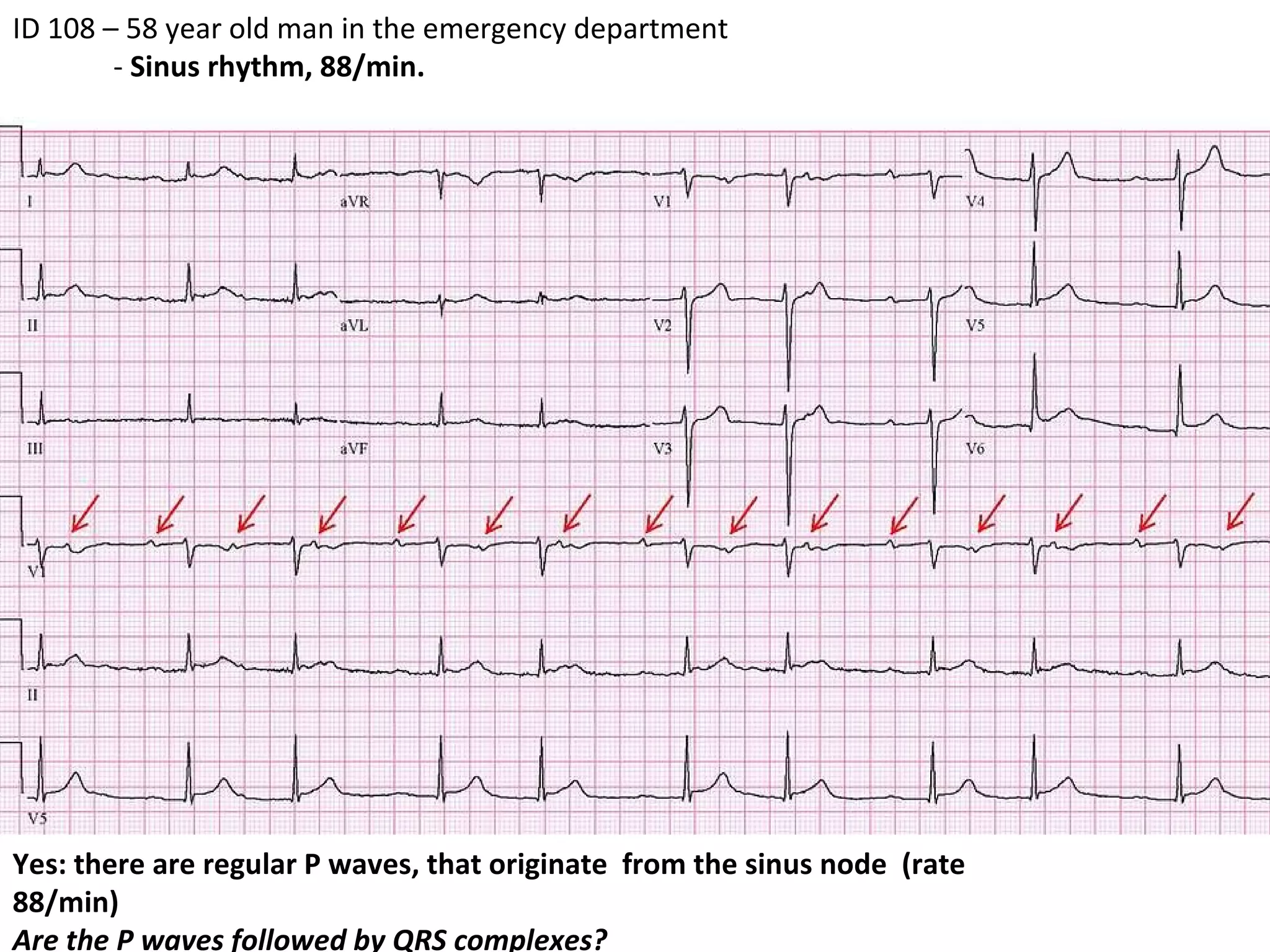 Stepwise interpretation of ECG ID108 | PPT