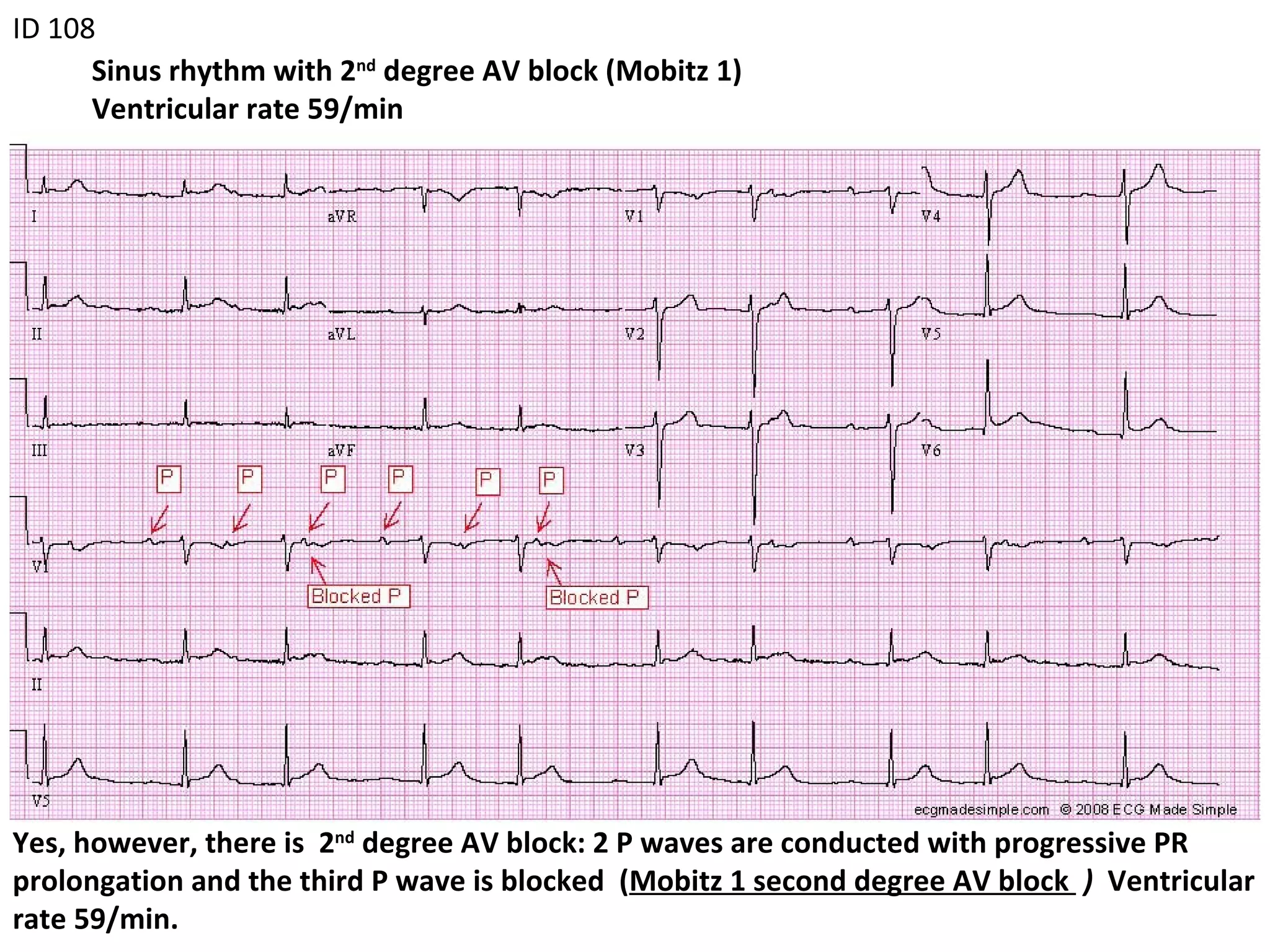 Stepwise interpretation of ECG ID108 | PPT