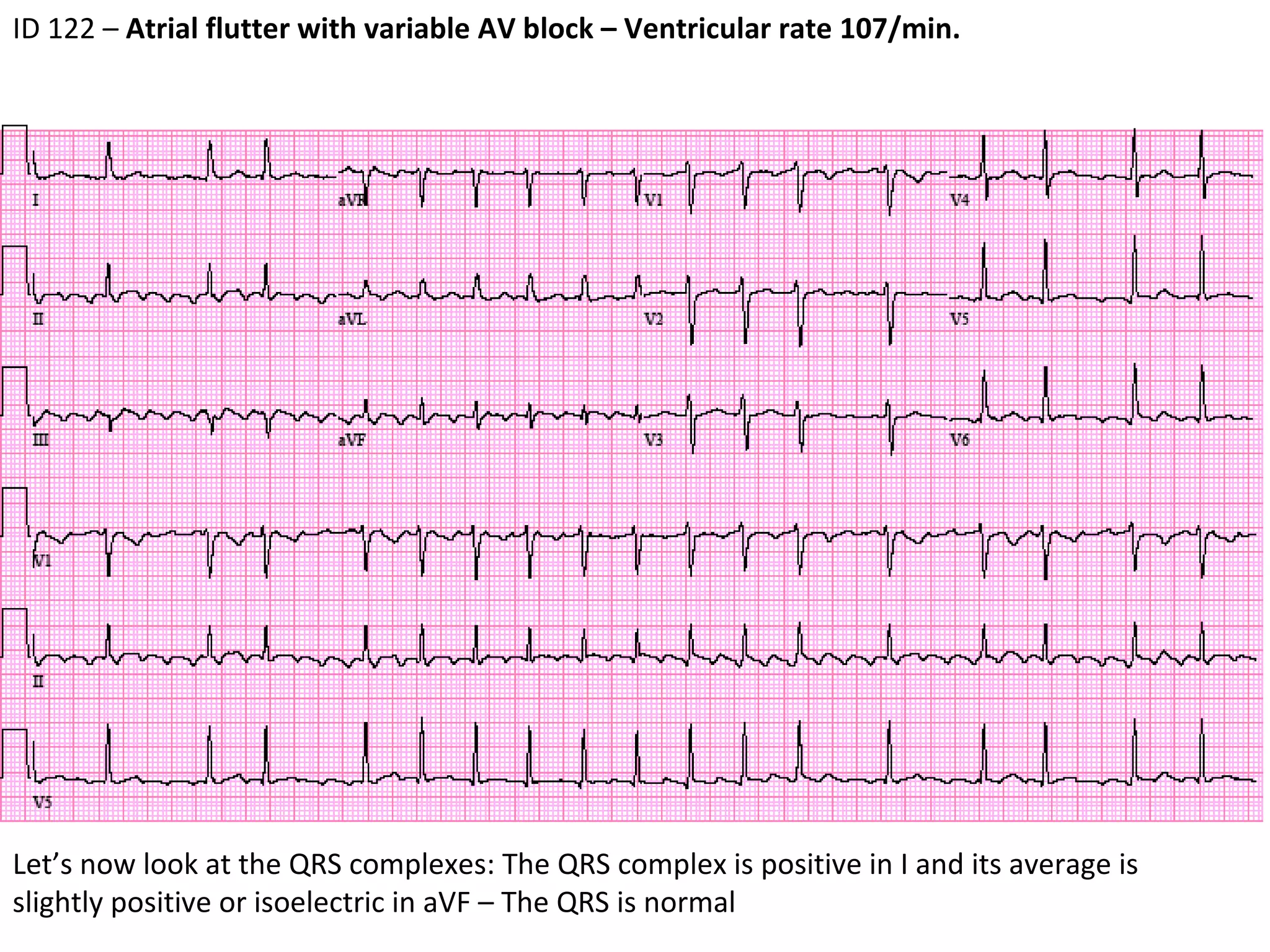 Stepwise interpretation of ECG ID122 | PPT