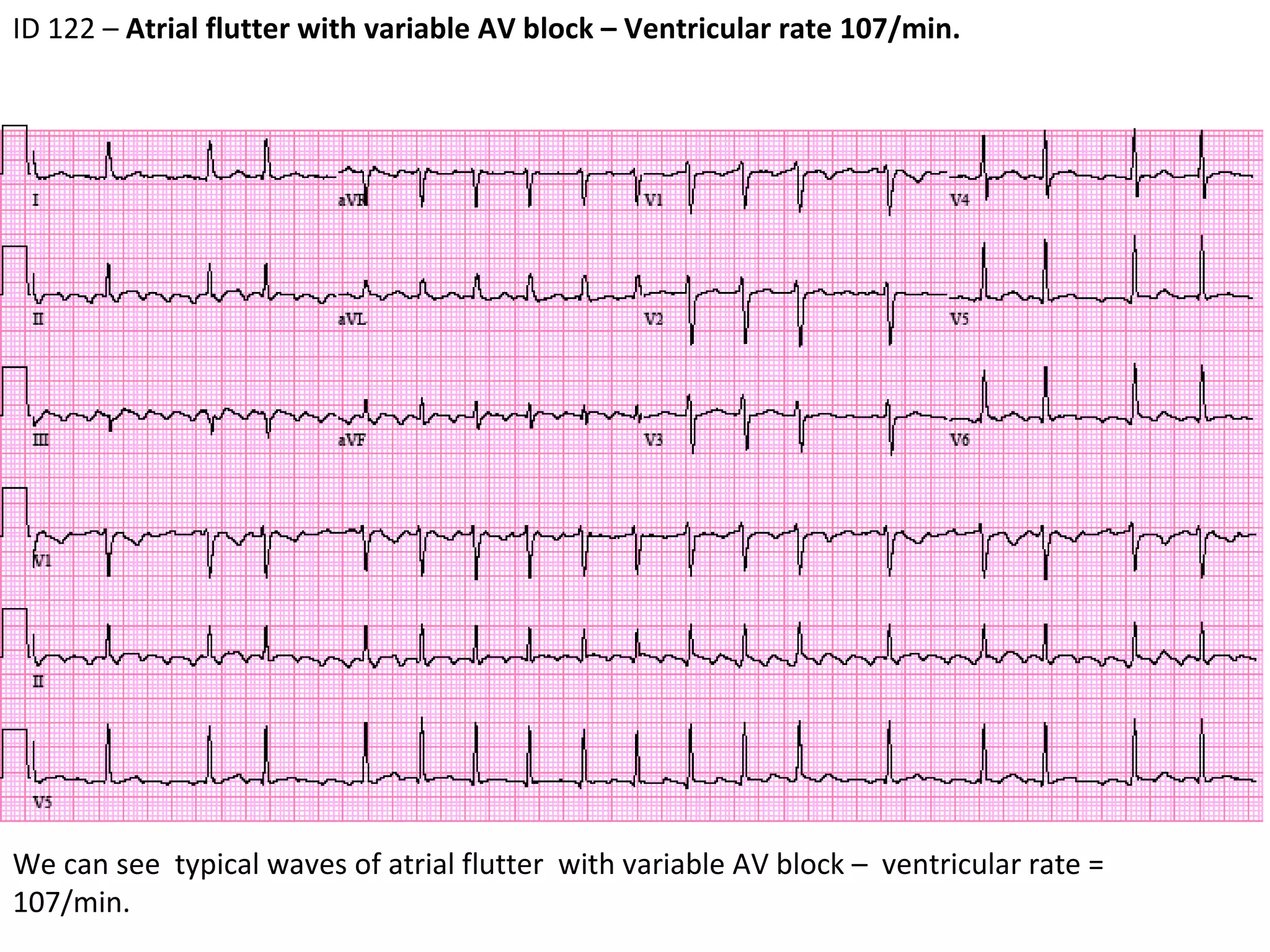 Stepwise interpretation of ECG ID122 | PPT