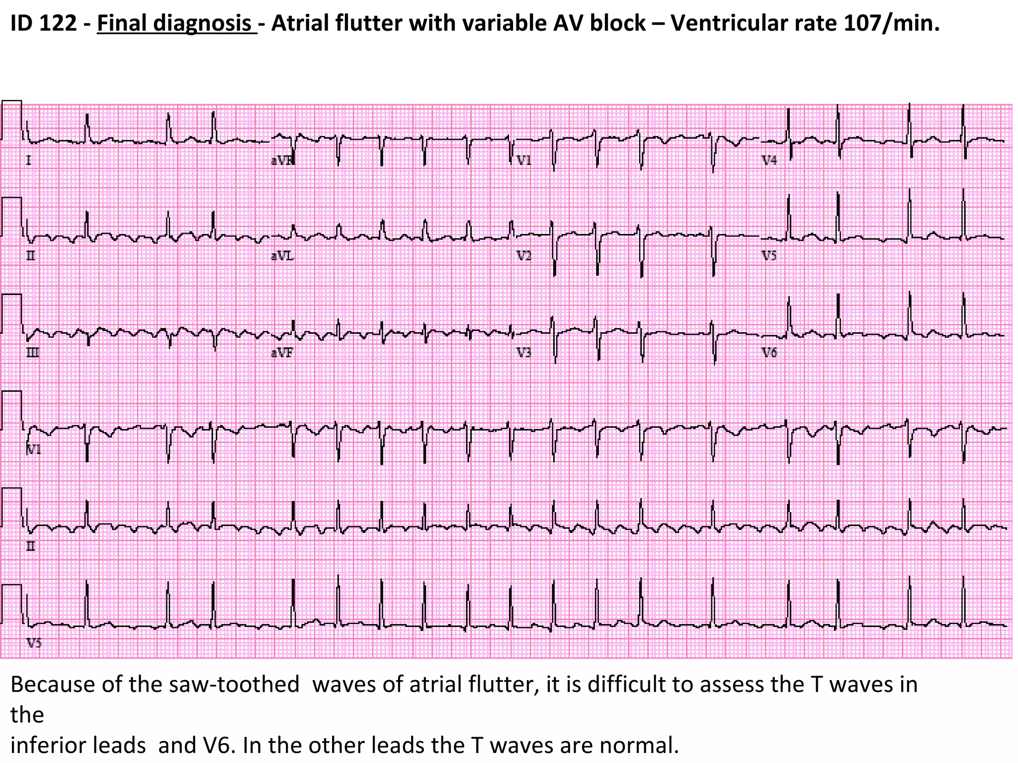 Stepwise interpretation of ECG ID122 | PPT