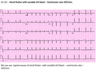 Stepwise interpretation of ECG ID122 | PPT