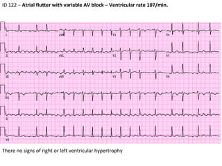 Stepwise interpretation of ECG ID122 | PPT