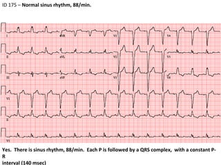 Stepwise interpretation of ECG ID175