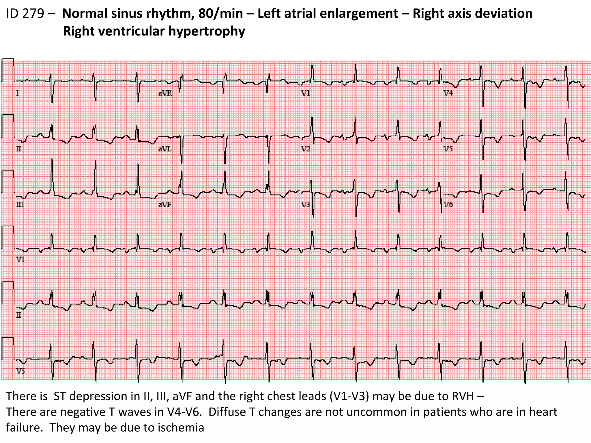 stepwise interpretation of ECG ID279 RVH | PPT
