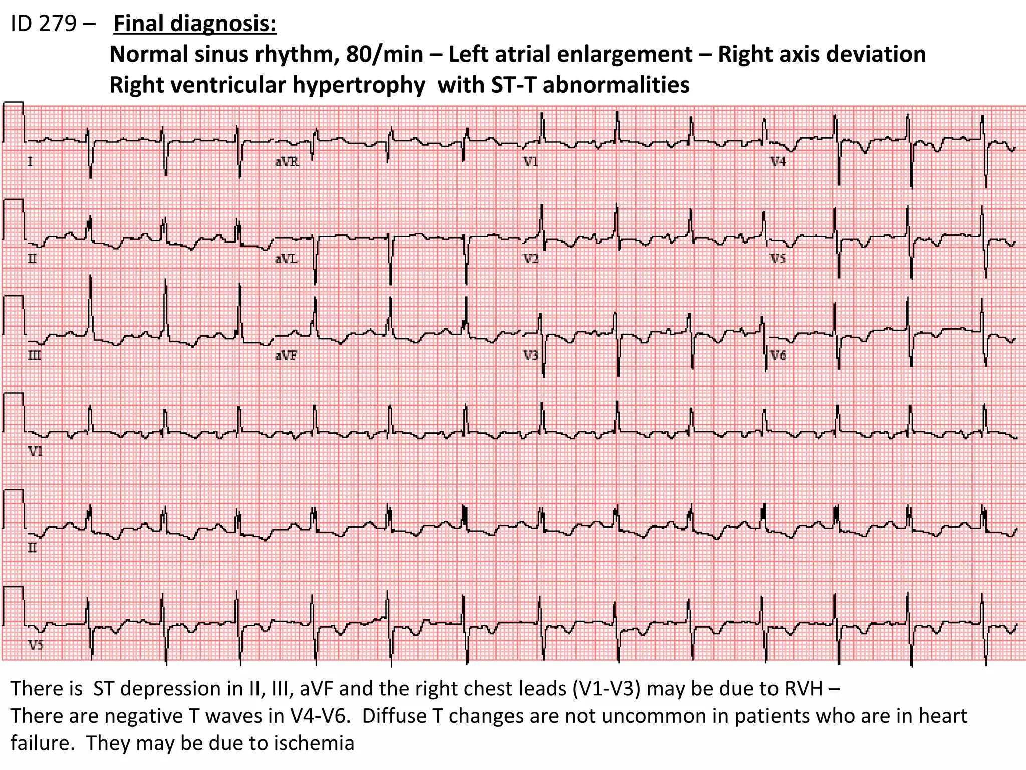 stepwise interpretation of ECG ID279 RVH | PPT
