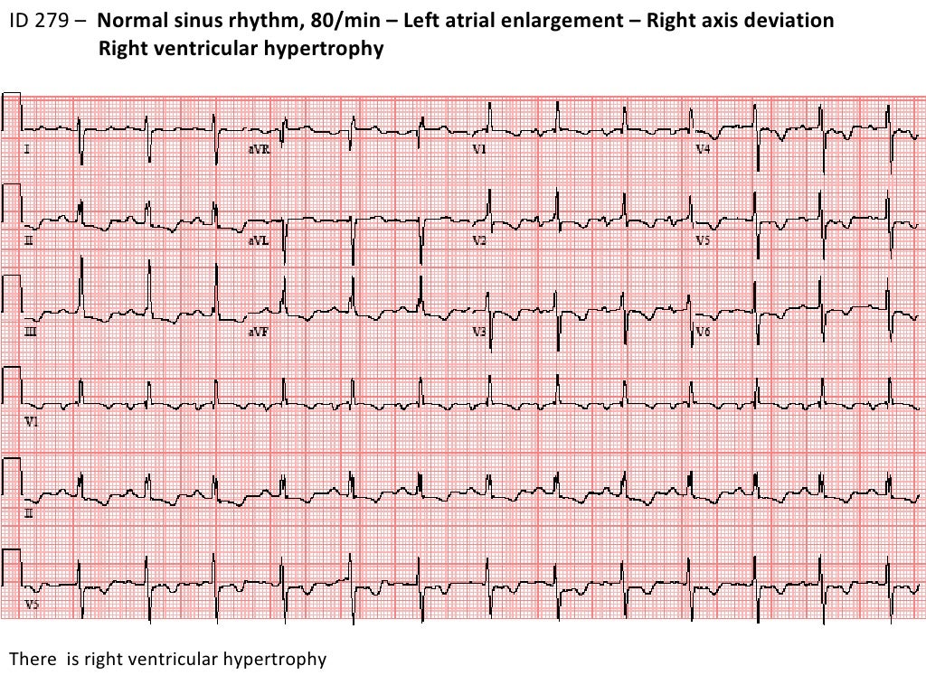 stepwise interpretation of ECG ID279 RVH
