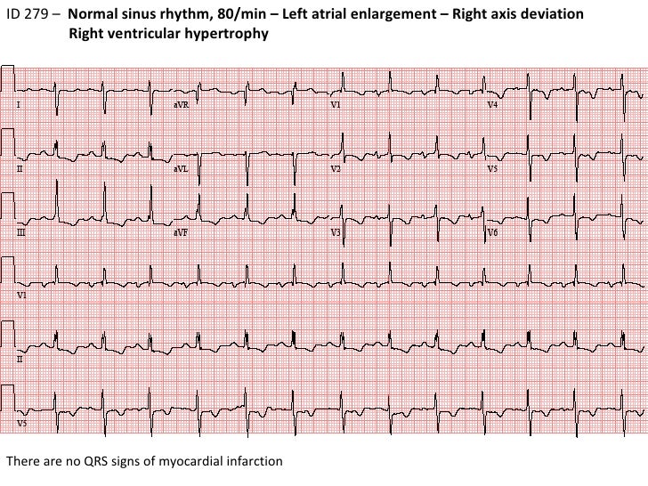 stepwise interpretation of ECG ID279 RVH