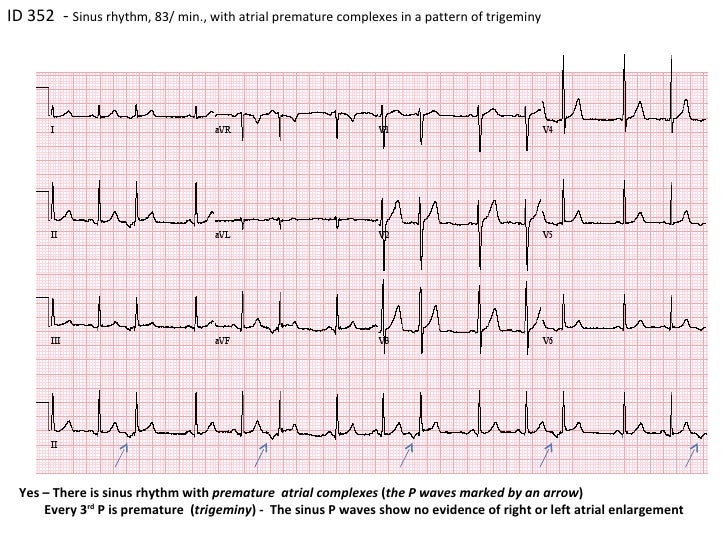 Stepwise interpretation of ECG ID372