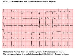 Stepwise interpretation of ECG ID383