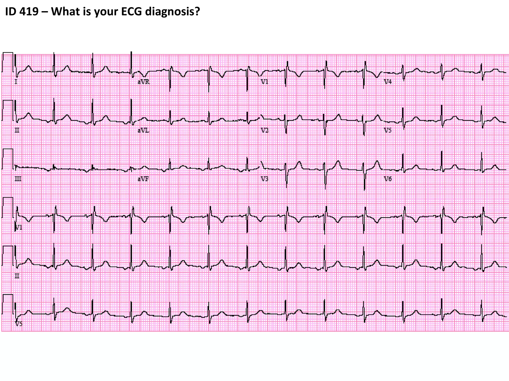 Stepwise interpretation of ECG ID419 | PPT Stepwise interpretation of ECG ID419 | PPT