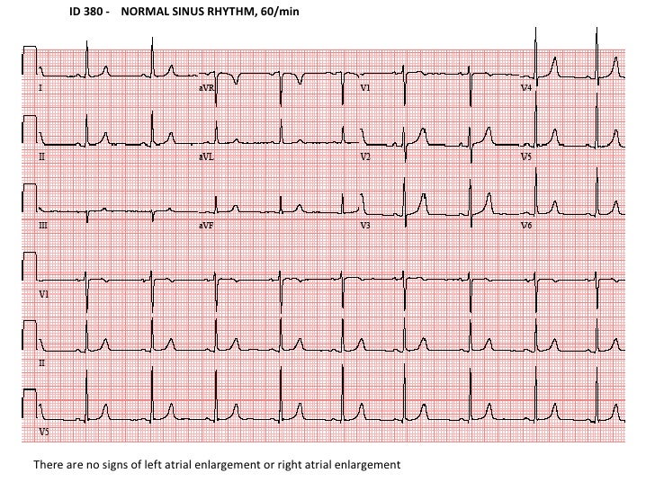 Stepwise interpretation of NORMAL ECG ID380