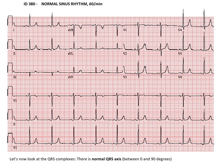 Stepwise interpretation of NORMAL ECG ID389