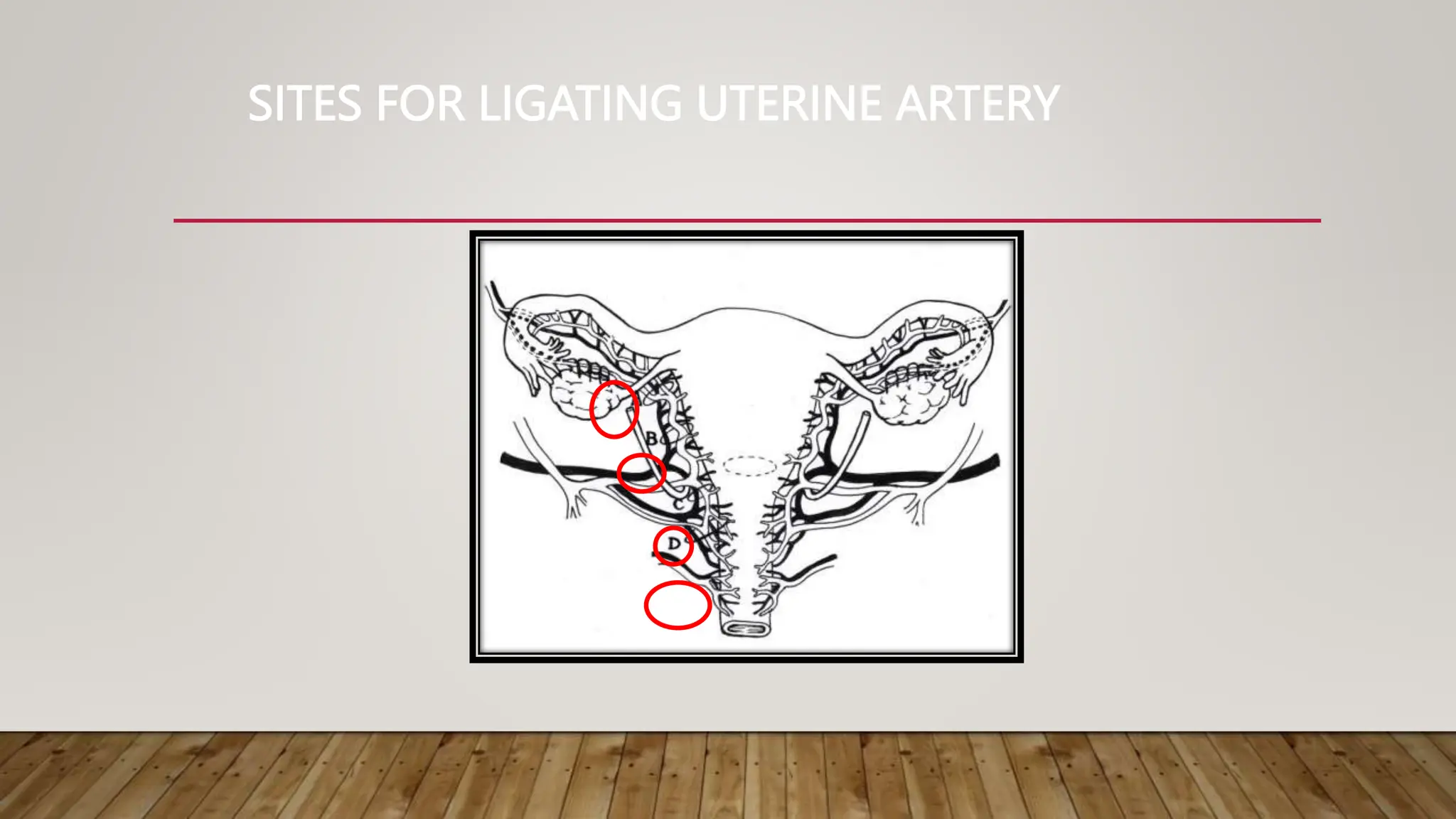 stepwisepelvicdevascularisation-180120130719.pptx