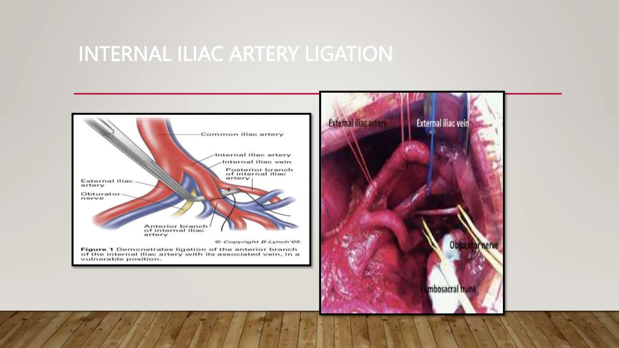 stepwisepelvicdevascularisation-180120130719.pptx