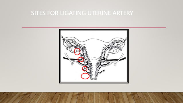 stepwisepelvicdevascularisation-180120130719.pptx | Pregnancy | Reproductive Health