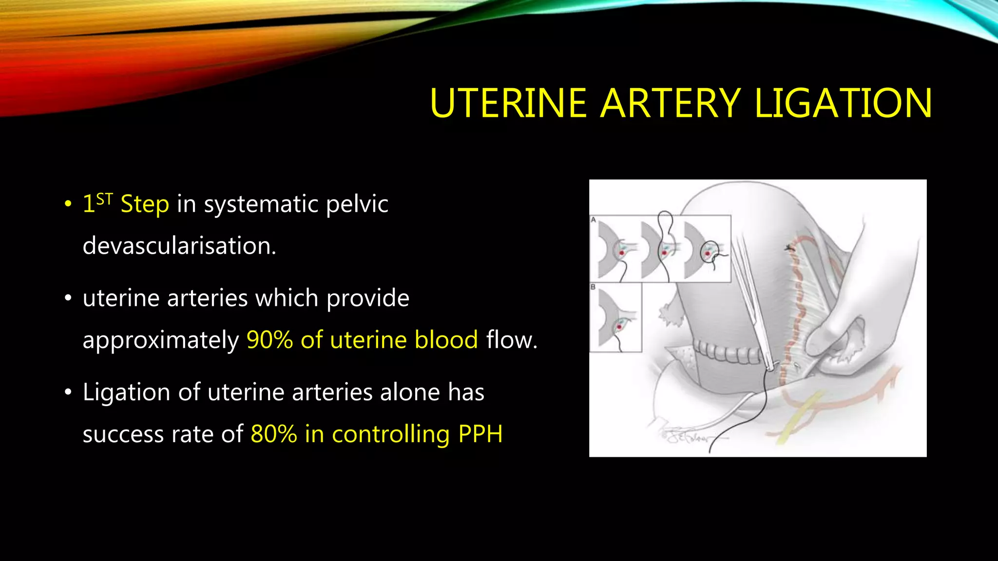 Step wise pelvic devascularisation | PPTX