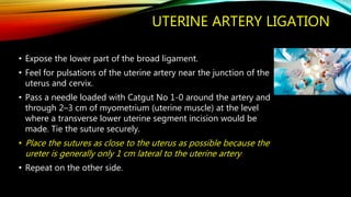 Step wise pelvic devascularisation | PPTX