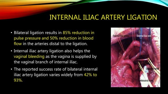 Step wise pelvic devascularisation | PPTX | Pregnancy | Reproductive Health