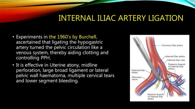 Step wise pelvic devascularisation | PPT