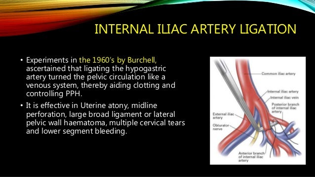 Step wise pelvic devascularisation