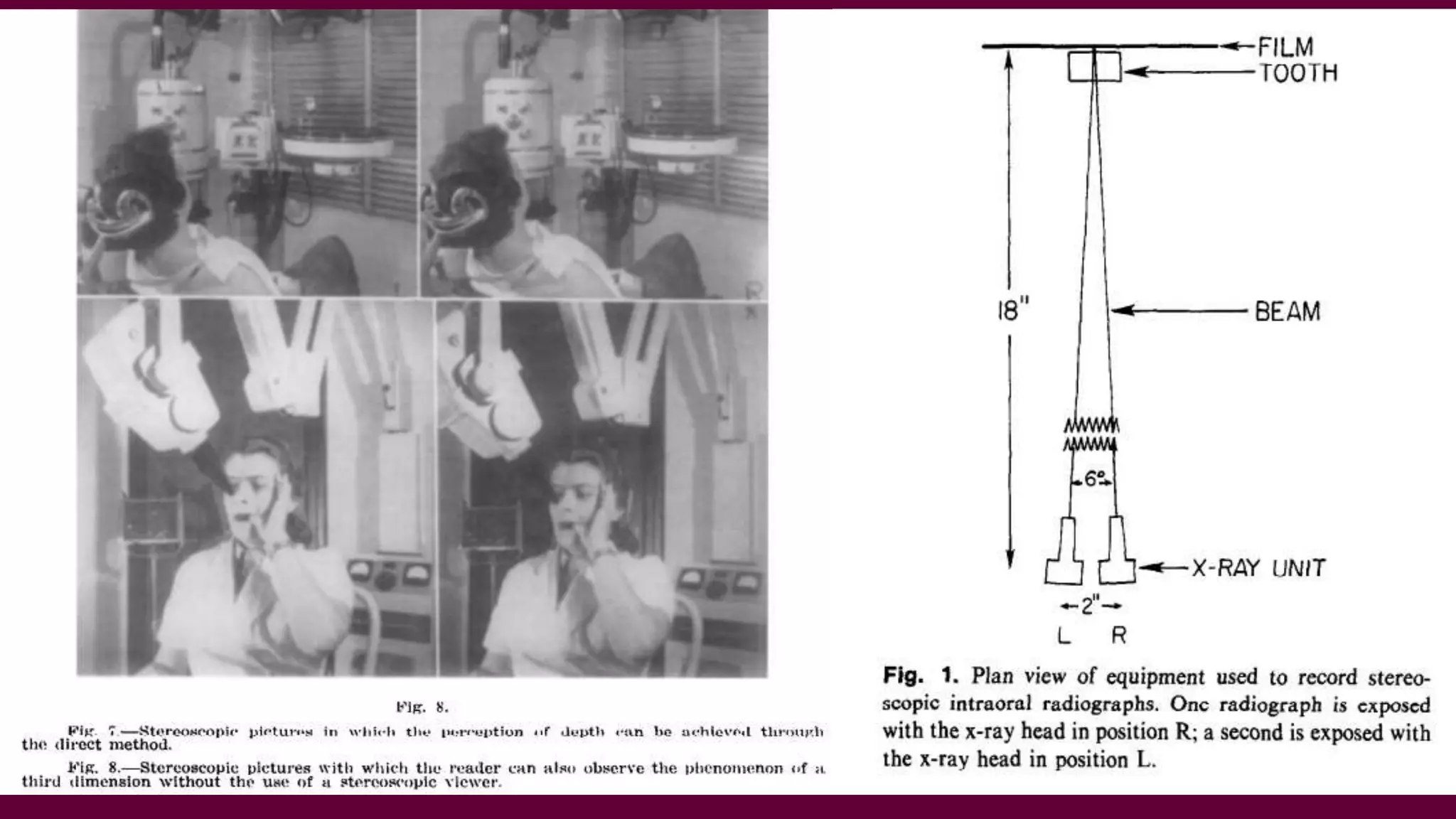 Stereoscopy in Dentistry | PPTX