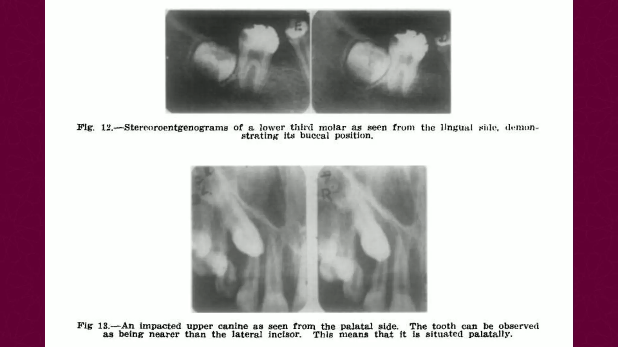 Stereoscopy in Dentistry | PPTX