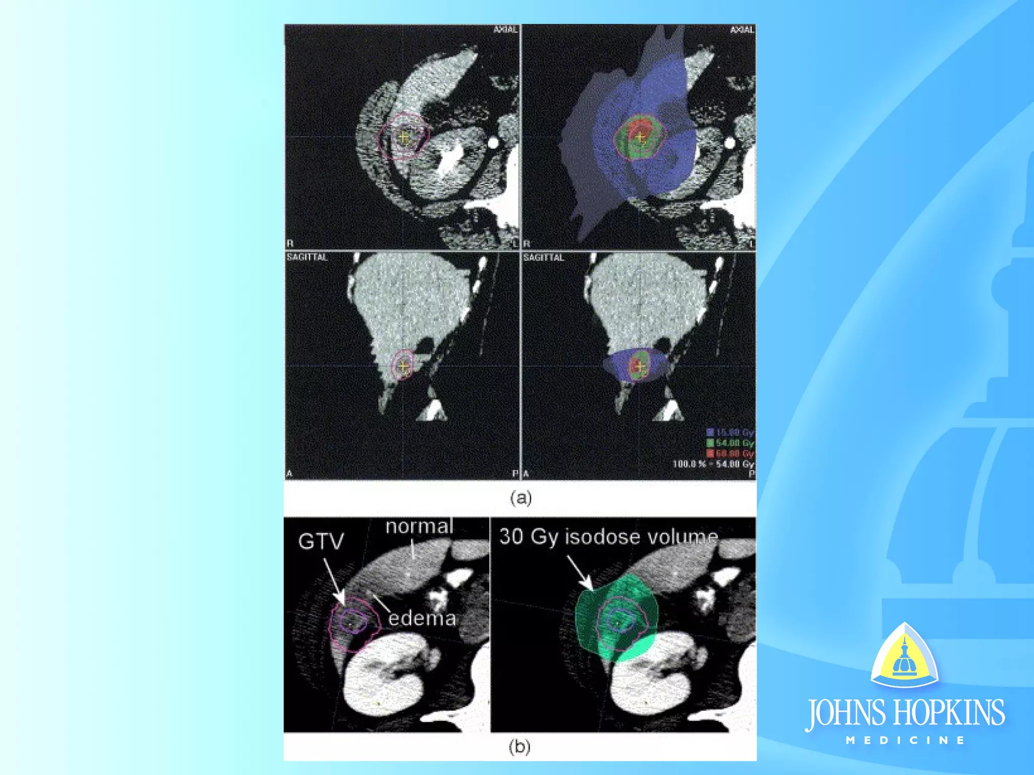 Stereotactic Body Radiation Therapy | PPT Stereotactic Body Radiation Therapy | PPT