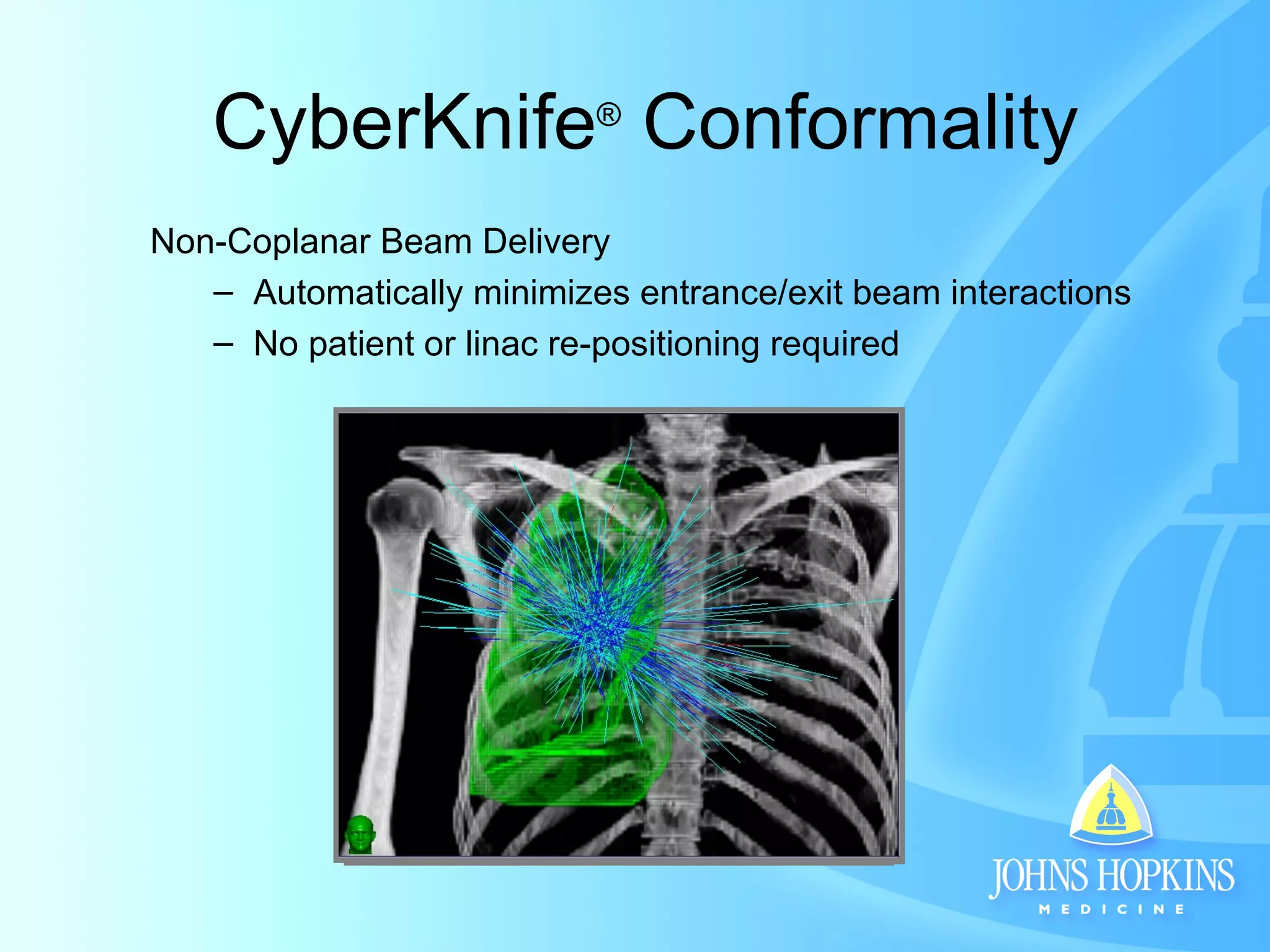 Stereotactic Body Radiation Therapy | PPT