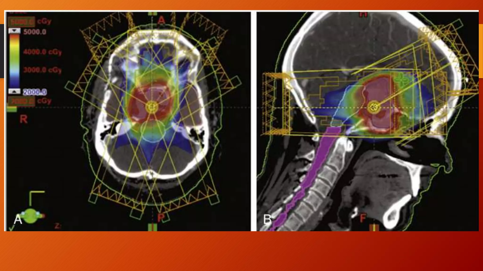 Stereotactic radiosurgery and radiotherapy | PPTX