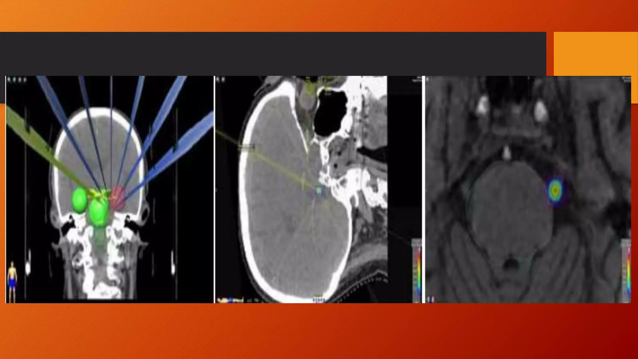 Stereotactic radiosurgery and radiotherapy | PPTX