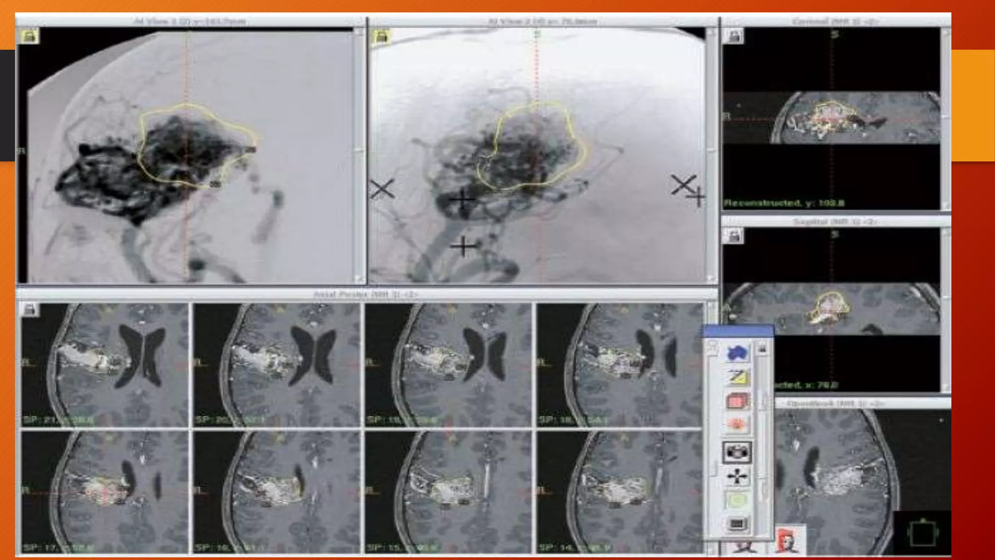 Stereotactic radiosurgery in arterio venous malformations | PPTX